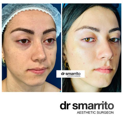 Cernes : enfin un traitement révolutionnaire à Lausanne