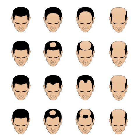 TYPES DE CALVITIE | Dr SMARRITO chirurgie esthétique